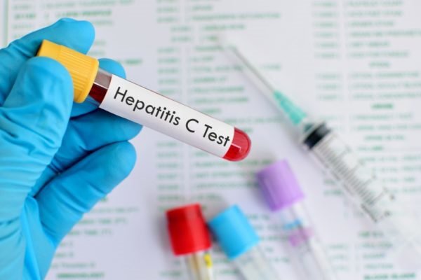 Tìm hiểu elisa test là gì và cách sử dụng trong chuẩn đoán y tế