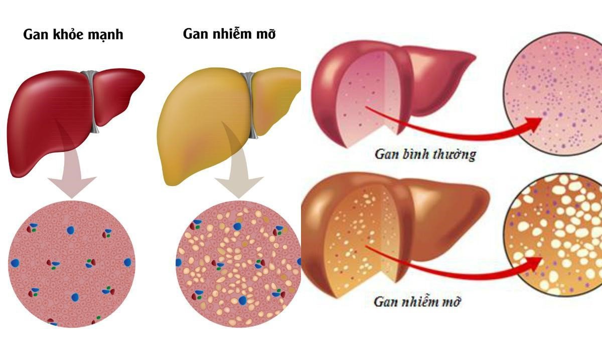 Cách kiểm tra chức năng gan gồm những gì đơn giản và hiệu quả